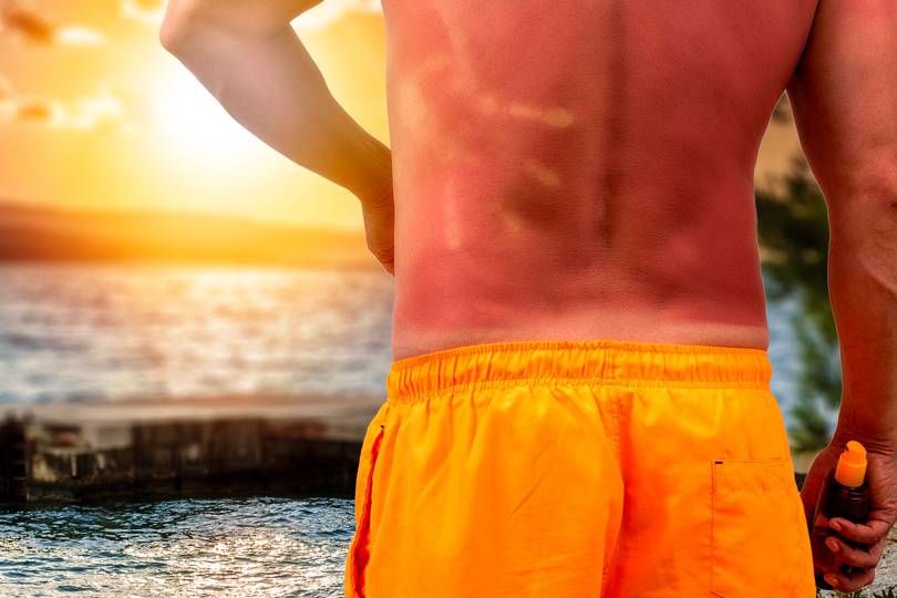 How to treat sunburn | British GQ